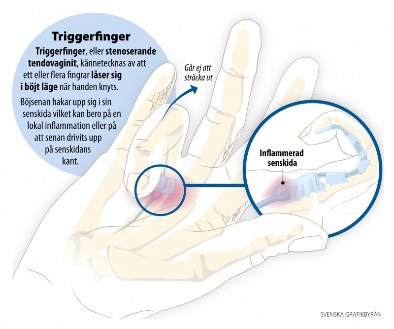 Triggerfinger (nodosa, tendovaginit) - Läkarhuset Strömmen